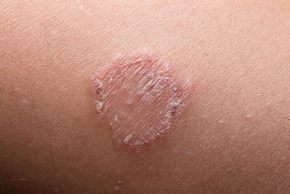 Tinea Corporis : Gejala, Penyebab, dan Pengobatan