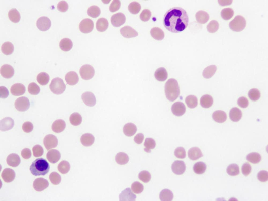 Coombs Test: Kegunaan, Proses, dan Membaca Hasil Tes | Hello Sehat