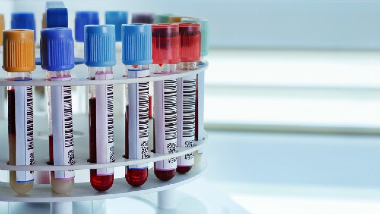 Cara Kerja Tes TUBEX untuk Mendeteksi Tipes - Hello Sehat