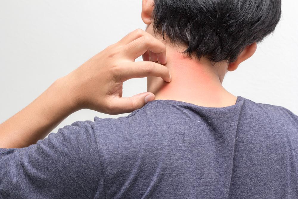 Atasi Kulit Gatal Akibat Gigitan Kutu Dengan 5 Cara Ini