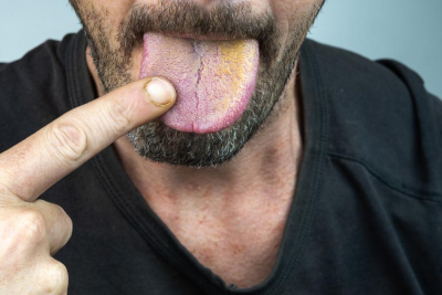 Radang Lidah (Glossitis): Gejala, Penyebab, Pengobatan, dll.