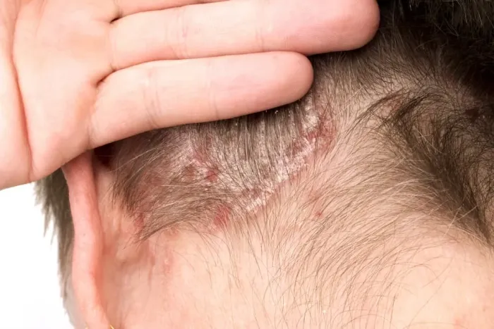Psoriasis Kulit Kepala, Inilah Penyebab dan Pengobatannya