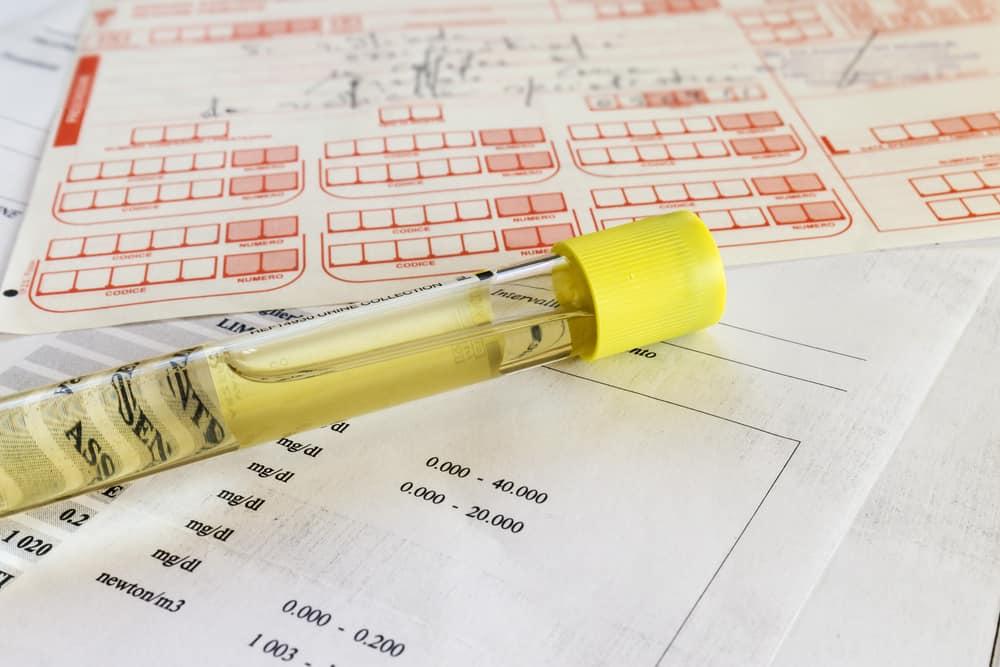 Sel Darah Putih atau Leukosit dalam Urine, Pertanda Apa?