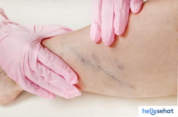 Gejala Deep Vein Thrombosis Tak Boleh Diabaikan, Ini Bahayanya