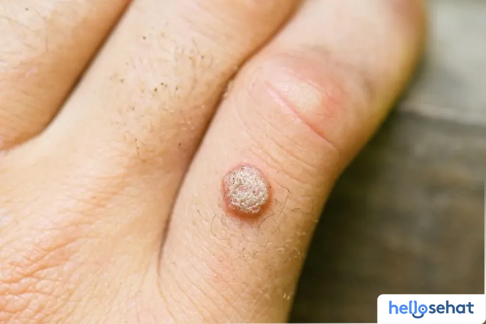 5 Cara Menghilangkan Kutil Membandel di Jari Tangan dan Kaki