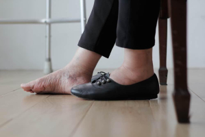 Edema (Pembengkakan): Gejala, Penyebab, Hingga Pengobatan