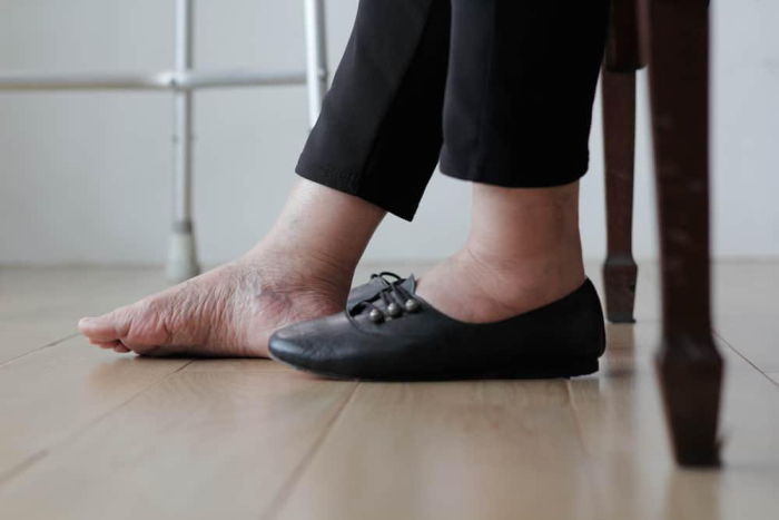 Edema (Pembengkakan): Gejala, Penyebab, Hingga Pengobatan