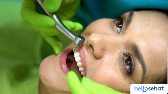 Bonding Gigi: Definisi, Tujuan, Prosedur, dll. - Hello Sehat