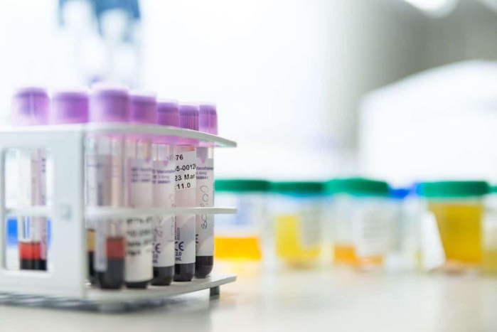 Tes Urine (Urinalisis): Berbagai Macam Jenis dan Fungsinya