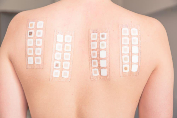Prosedur Tes Tempel untuk Alergi (Skin Patch Test) - Hello Sehat