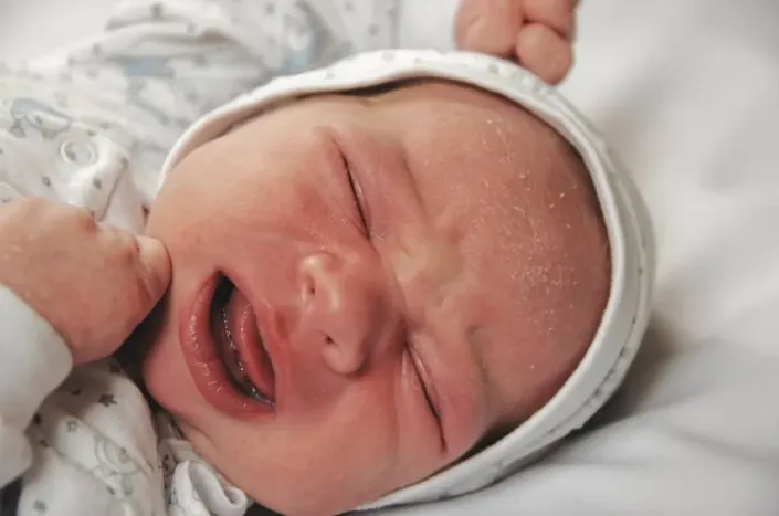 Cradle Cap (Dermatitis Seboroik pada Bayi), Apa Penyebabnya?