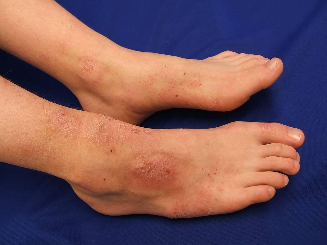 Dermatitis Stasis: Gejala, Penyebab, dan Pengobatan