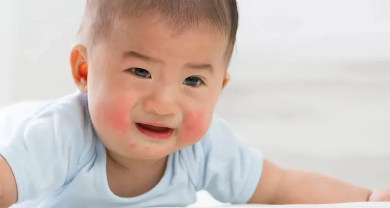 10 Penyebab Ruam Merah pada Bayi dan Cara Mengatasinya