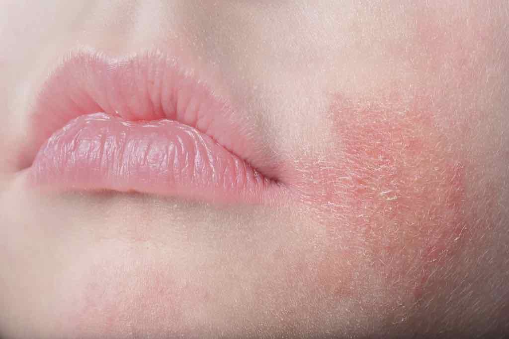 Dermatitis Perioral: Gejala, Penyebab, dan Pengobatan