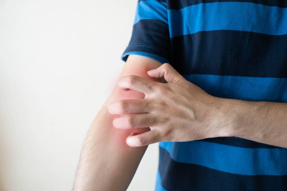 Alergi Pada Kulit: Jenis, Gejala, Cara Mengatasi, dan Cara Mencegah