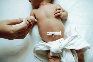 Pusar Bodong pada Bayi: Gejala, Penyebab, dan Pengobatan