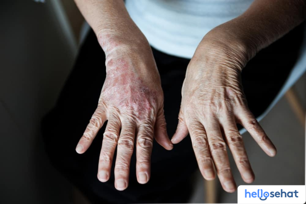 Psoriasis Pustulosa: Gejala, Penyebab, Pengobatan - Hello Sehat