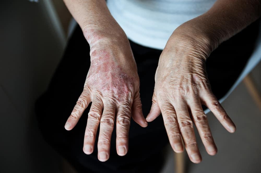 Psoriasis Pustulosa: Gejala, Penyebab, Pengobatan - Hello Sehat