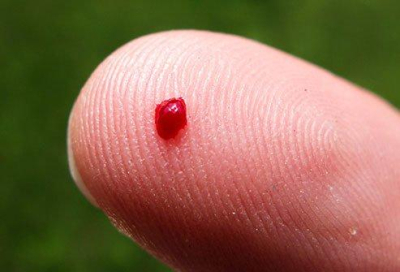 Luka Terbuka: Jenis dan Cara Perawatan - Hello Sehat