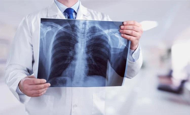 Pleuropneumonia pada Hasil Rontgen Dada, Ketahui Artinya