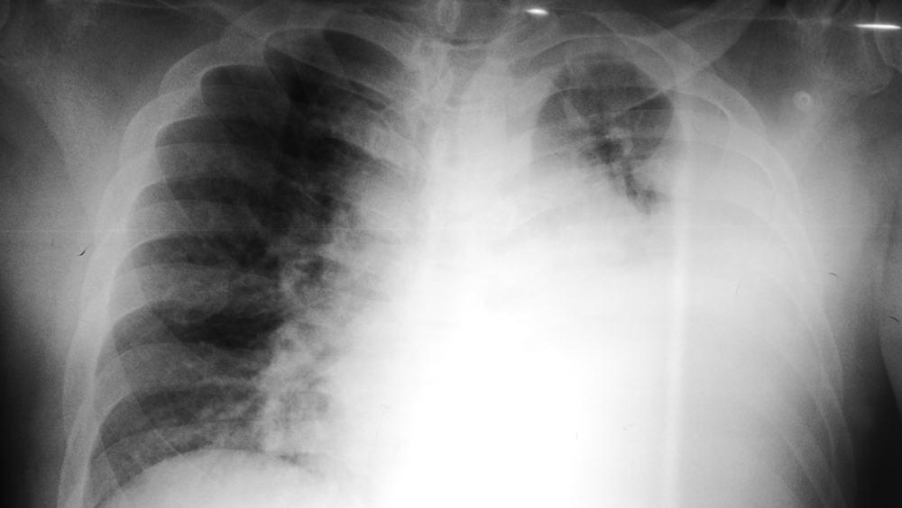 Empiema: Gejala, Penyebab, dan Pengobatan | Hello Sehat