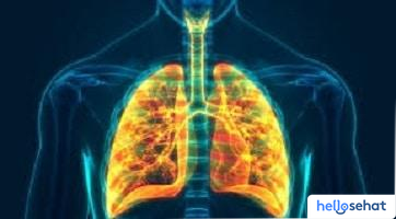 9 Komplikasi Akibat Penyakit Paru Obstruktif Kronis (PPOK)