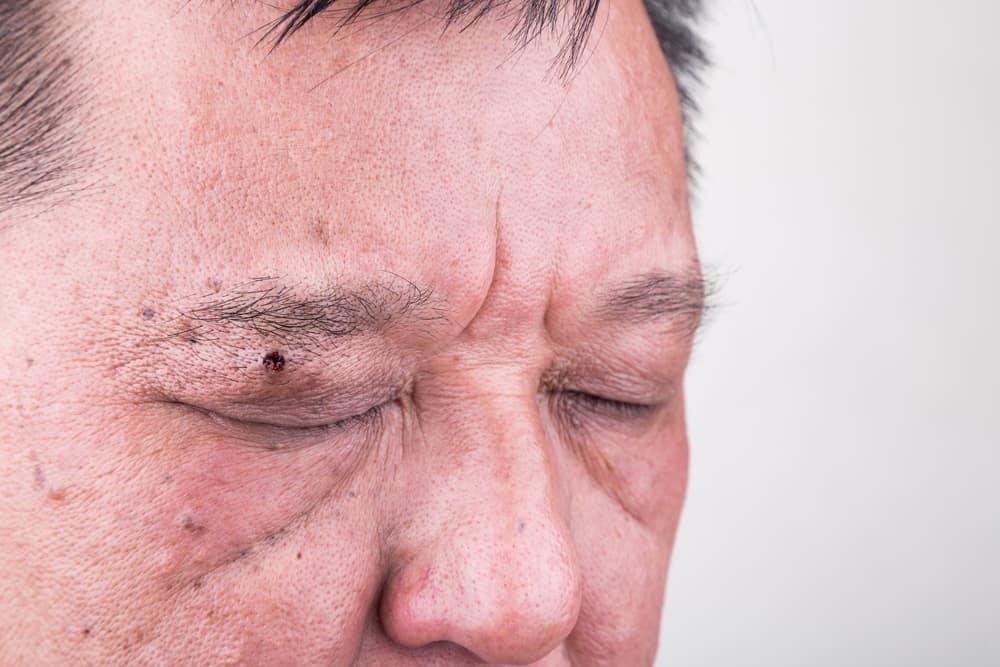 Karsinoma Sel Basal: Gejala, Penyebab, dan Pengobatan • Hello Sehat