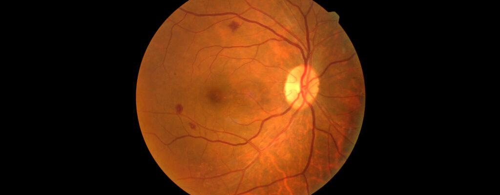 Retinopati Diabetik: Gejala, Pengobatan, dan Pencegahan
