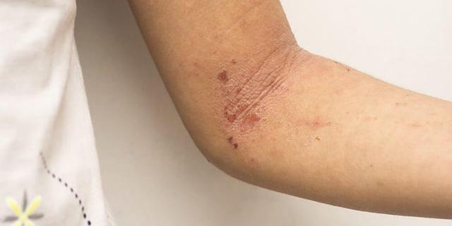 Intertrigo: Gejala, Penyebab, dan Cara Mengobati - Hello Sehat