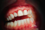 Gingivitis (Radang Gusi): Gejala, Penyebab, Pengobatan, dll.