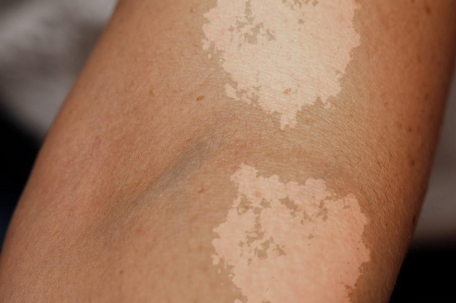 Pityriasis Alba: Gejala, Penyebab, dan Pengobatan - Hello Sehat