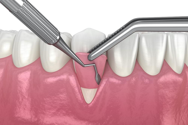 Resesi Gingiva (Gusi Turun): Gejala, Penyebab, dan Pengobatan
