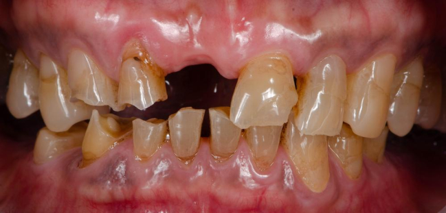 Resesi Gingiva (Gusi Turun): Gejala, Penyebab, dan Pengobatan