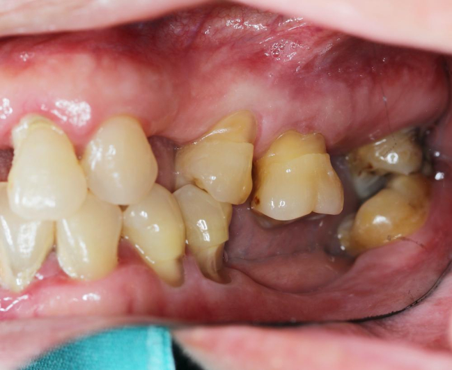 Resesi Gingiva (Gusi Turun): Gejala, Penyebab, dan Pengobatan