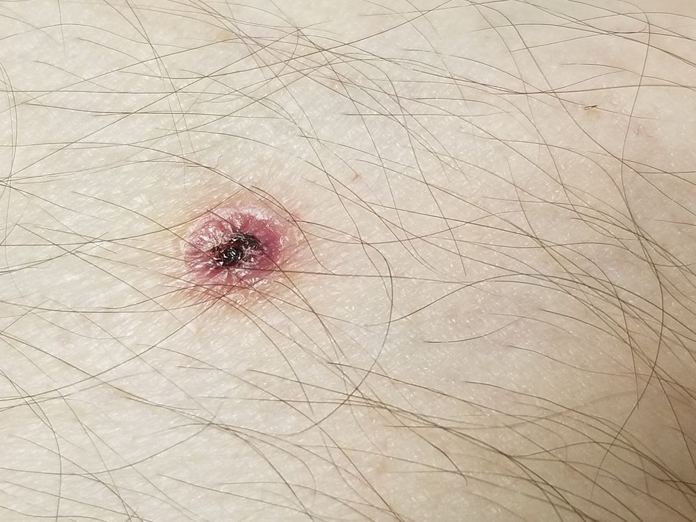 Pyoderma Gangrenosum: Obat, Gejala, dll. | Hello Sehat
