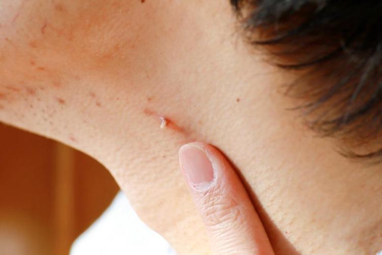 Kutil di Leher: Gejala, Penyebab, Pengobatan - Hello Sehat