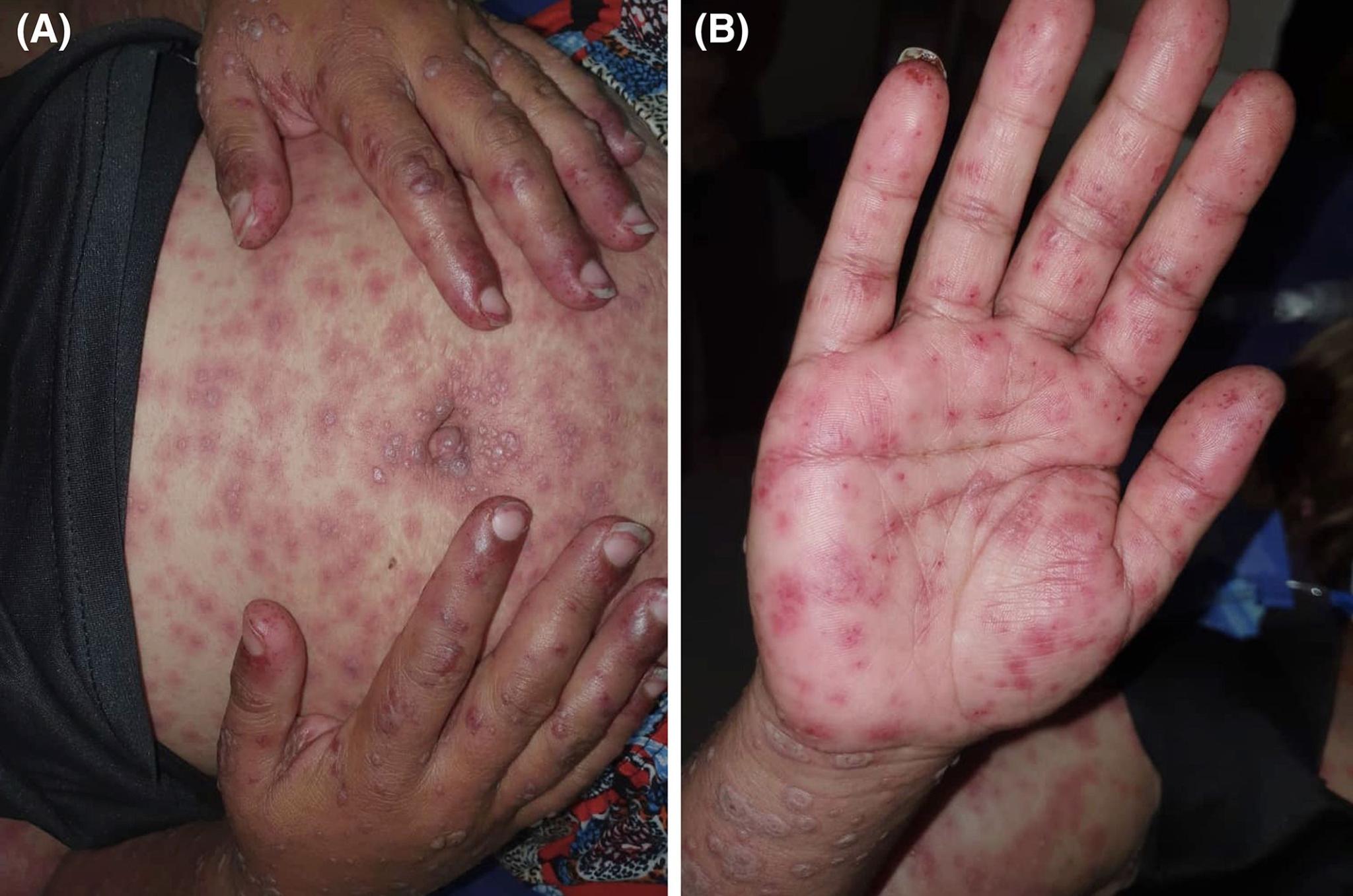 Pengalaman Saya Melewati Masa Kritis Steven Johnson Syndrome • Hello Sehat