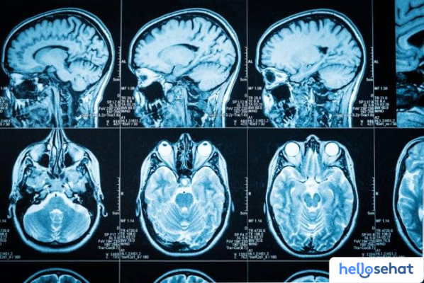 CT Scan Kepala: Proses, Hasil Tes, dan Risiko - Hello Sehat