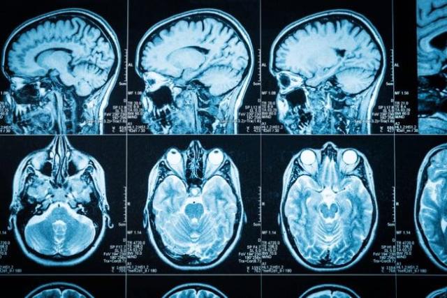 CT Scan Kepala: Proses, Hasil Tes, dan Risiko - Hello Sehat