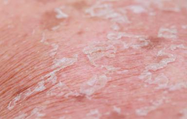 Dermatitis Neglecta: Gejala, Penyebab, dan Pengobatan - Hello Sehat