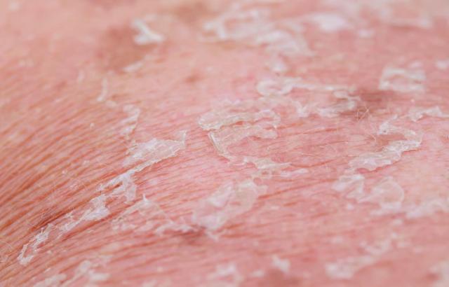 Dermatitis Neglecta: Gejala, Penyebab, dan Pengobatan - Hello Sehat