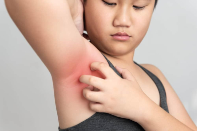 Eritrasma (Erythrasma): Penyebab, Pengobatan, dll. - Hello Sehat