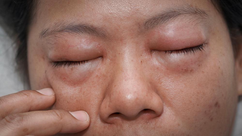 Selulitis Orbita Penyebab Gejala Pengobatan Hello Sehat