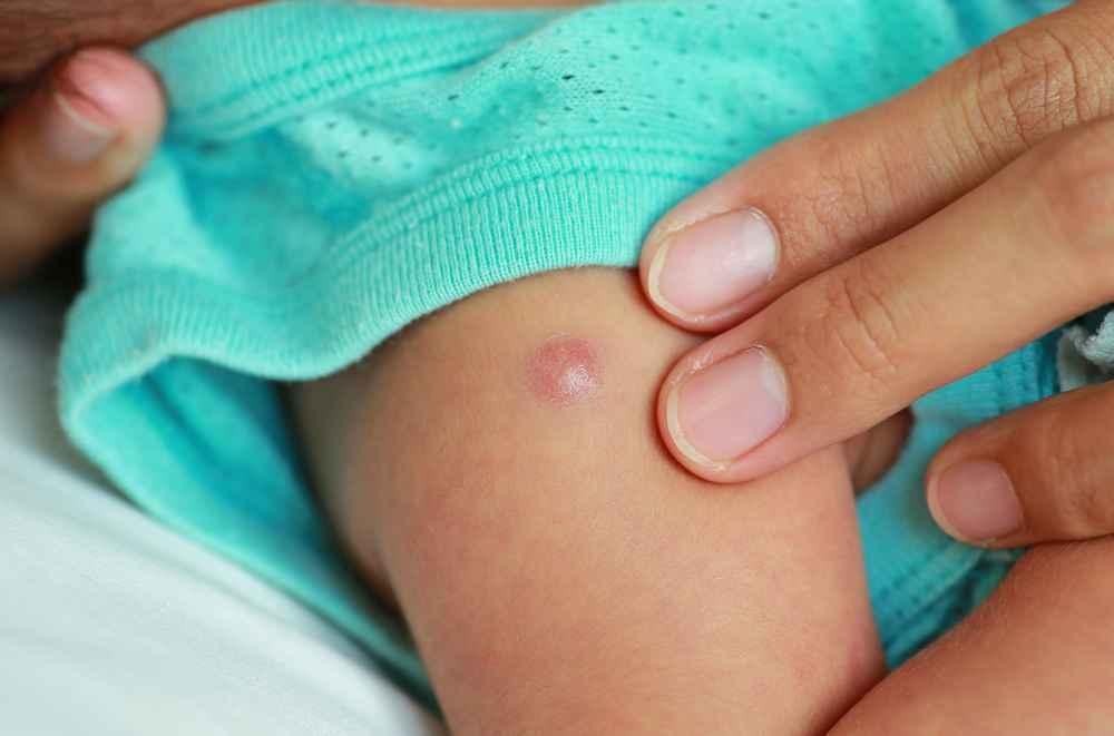 Bisul pada Bayi: Memahami Penyebab dan Penanganannya