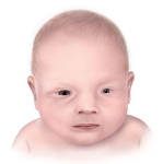 Microphthalmia, Kelainan Mata Sejak Bayi Dalam Kandungan