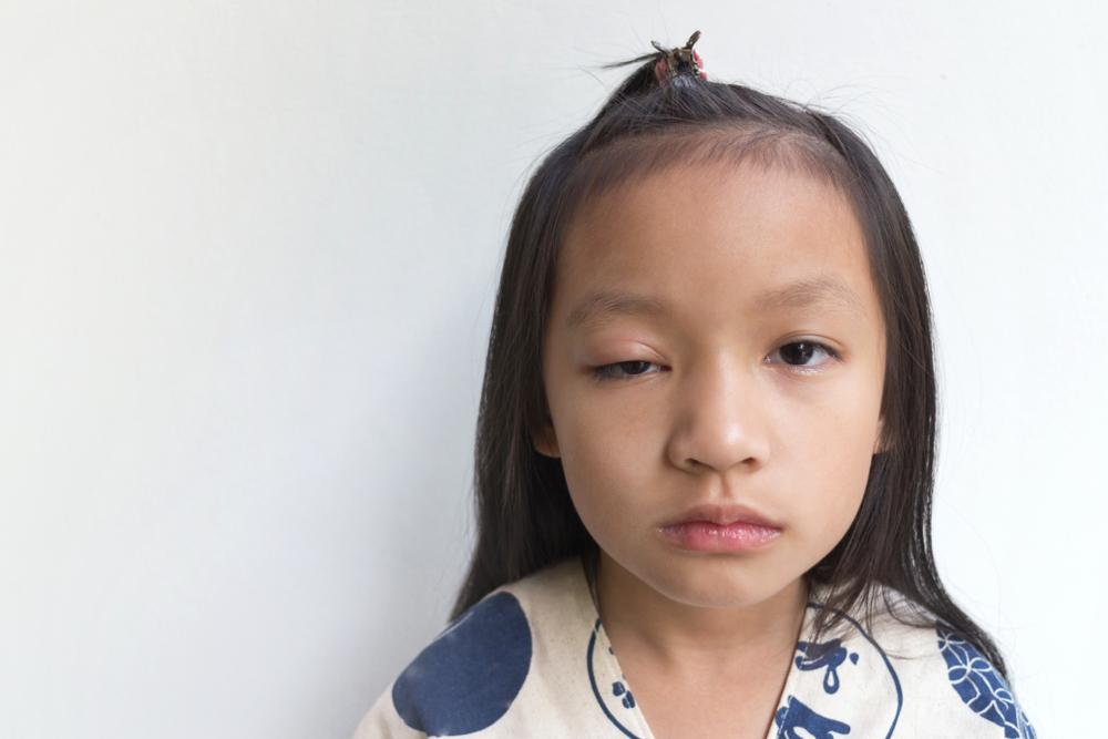 Microphthalmia, Kelainan Mata Sejak Bayi Dalam Kandungan