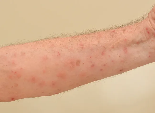 6 Gejala Scabies (Kudis) serta Tanda-Tanda Sembuhnya