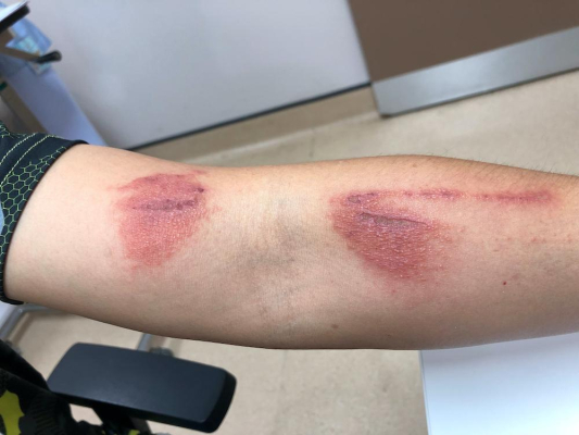 5 Penyebab Dermatitis Kontak yang Umum Dikenal - Hello Sehat