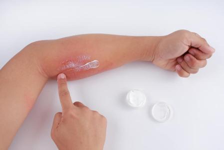 7 Salep Gatal yang Ampuh dan Aman Digunakan pada Kulit