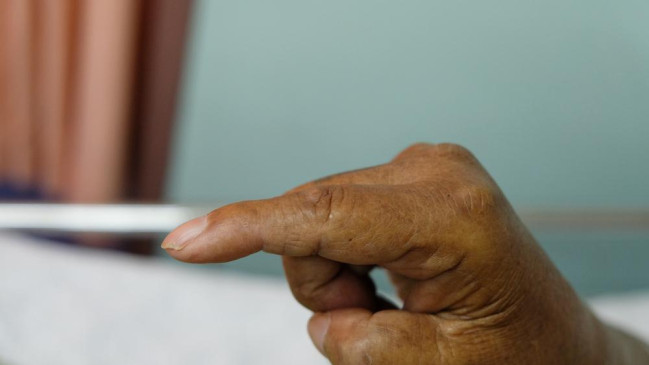 Clubbing Finger: Gejala, Penyebab, Pengobatan, dll. - Hello Sehat